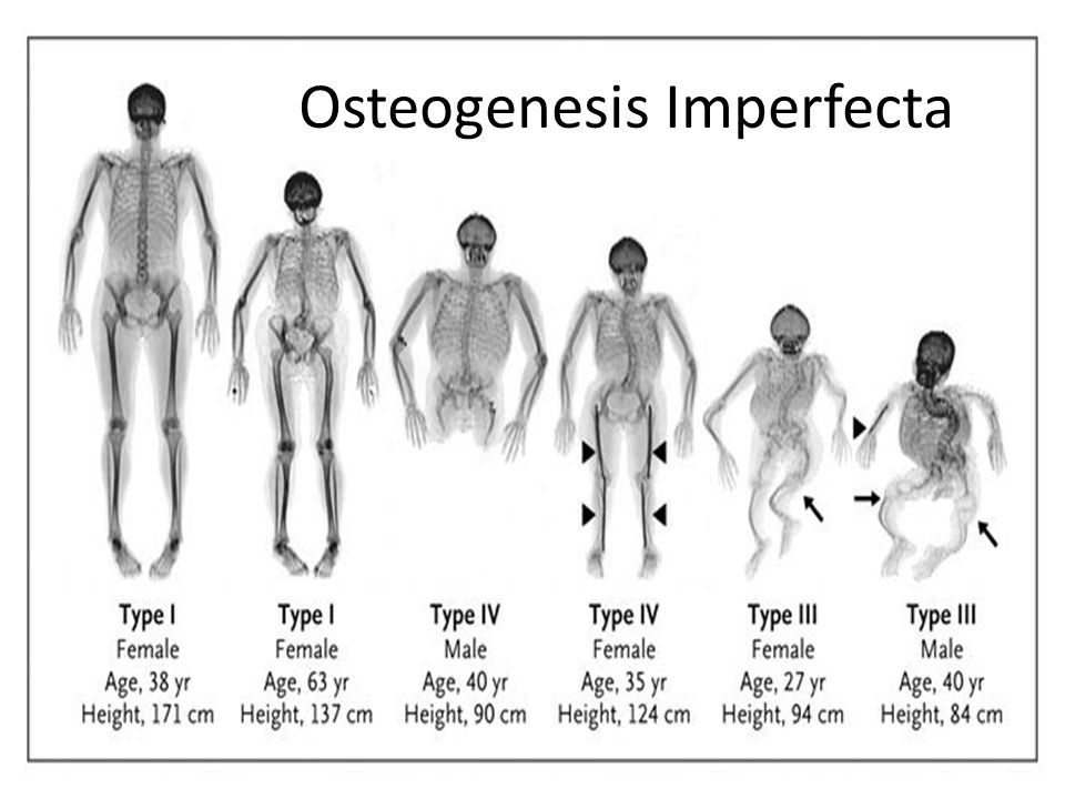 Qué es la osteogénesis - Clínica Martín Gómez Traumatólogos