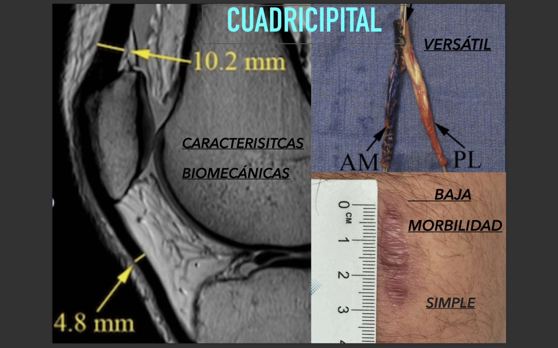 ¿Qué plastia elegir para la reconstrucción de ligamento cruzado ...
