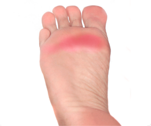 Metatarsalgia - Clínica Martín Gómez Traumatólogos