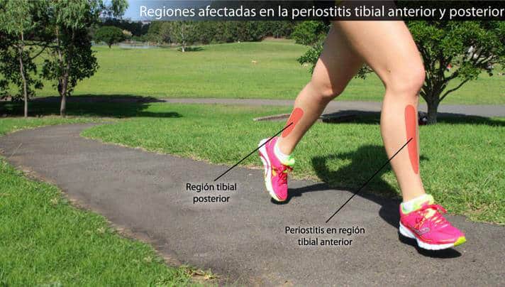 Periostitis tibial al correr: causas, síntomas y tramtamiento