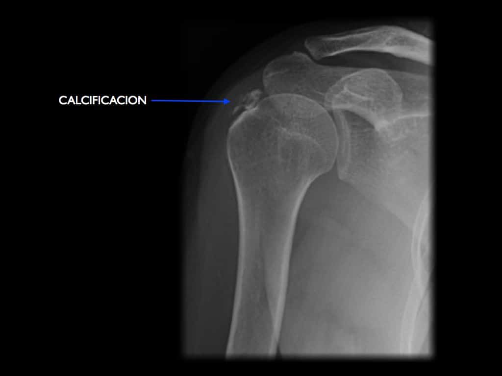 Cómo Tratar Las Calcificaciones De Hombro – YLEAV