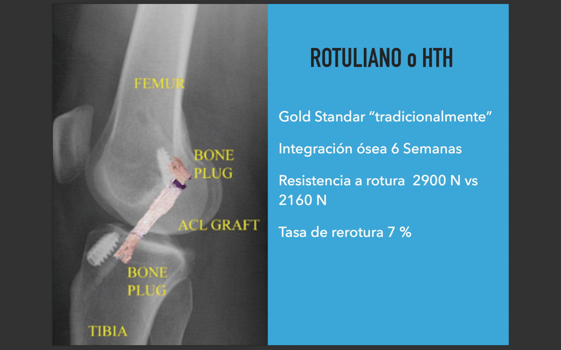 ¿Qué plastia elegir para la reconstrucción de ligamento cruzado ...
