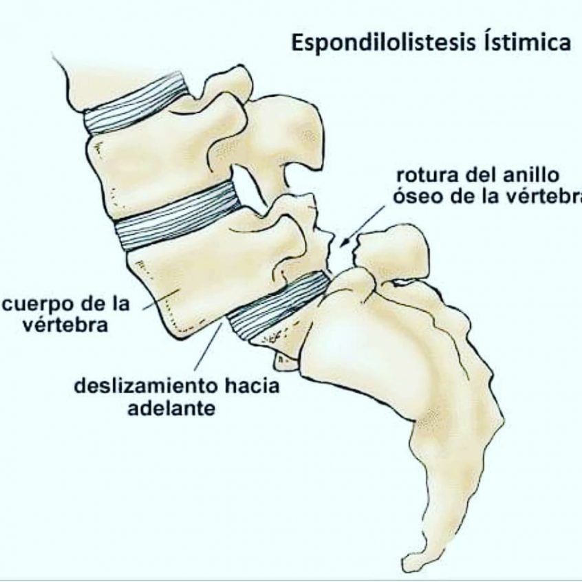 Qué es la espondilolistesis - Clínica Martín Gómez Traumatólogos