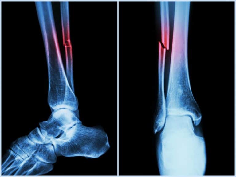 Fractura de tibia y peroné - Clínica Martín Gómez Traumatólogos Fractura de tibia y peroné - Clínica Martín Gómez Traumatólogos